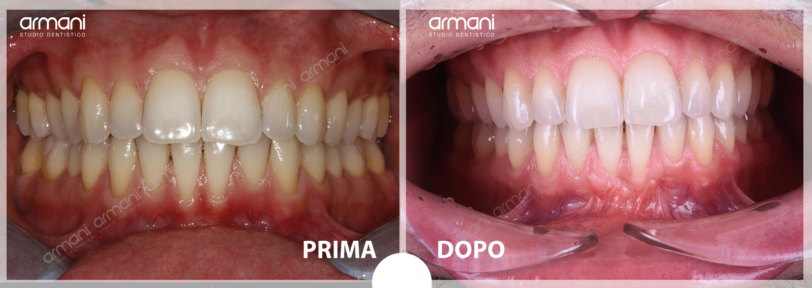 Recessione Gengivale a Verona - Studio Dentistico Armani