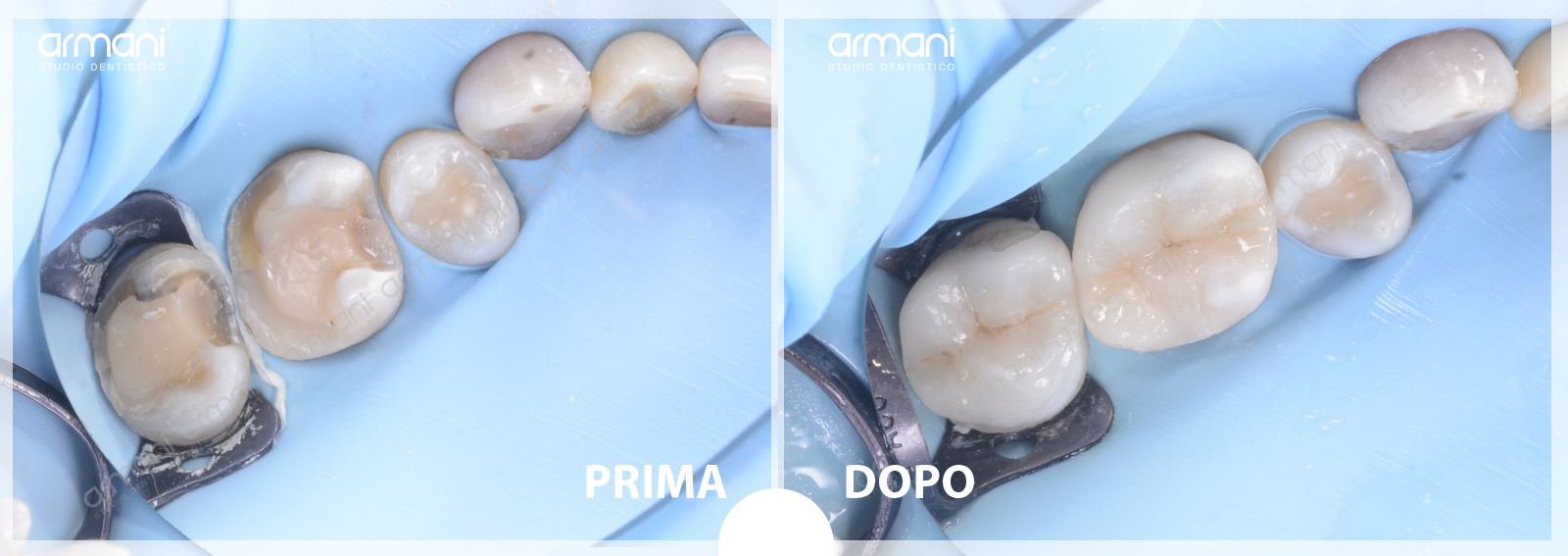 Intarsio Dentale a Verona - Studio Dentistico Armani