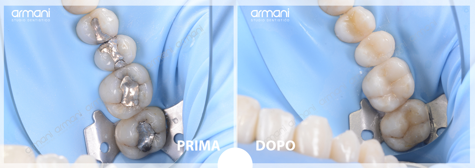 Intarsio Dentale a Verona - Studio Dentistico Armani