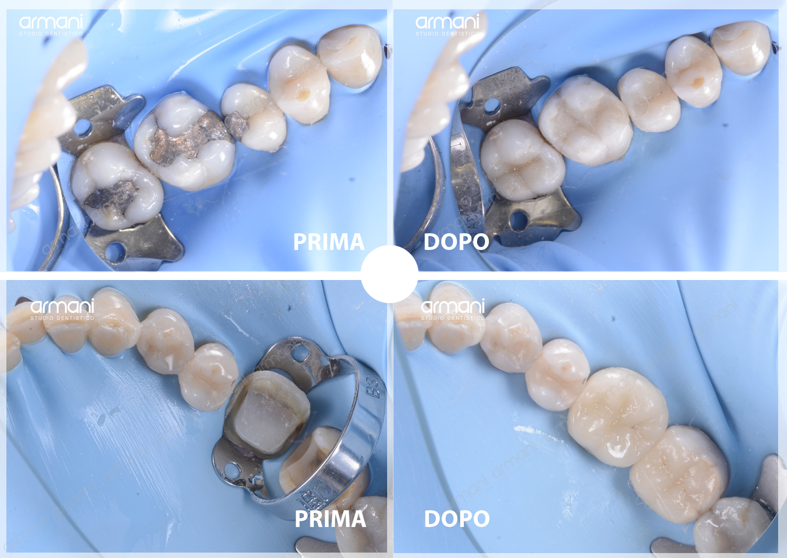 Intarsio Dentale a Verona - Studio Dentistico Armani