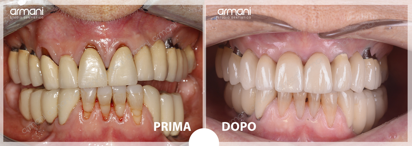 Protesi Dentale Fissa a Verona - Studio Dentistico Armani
